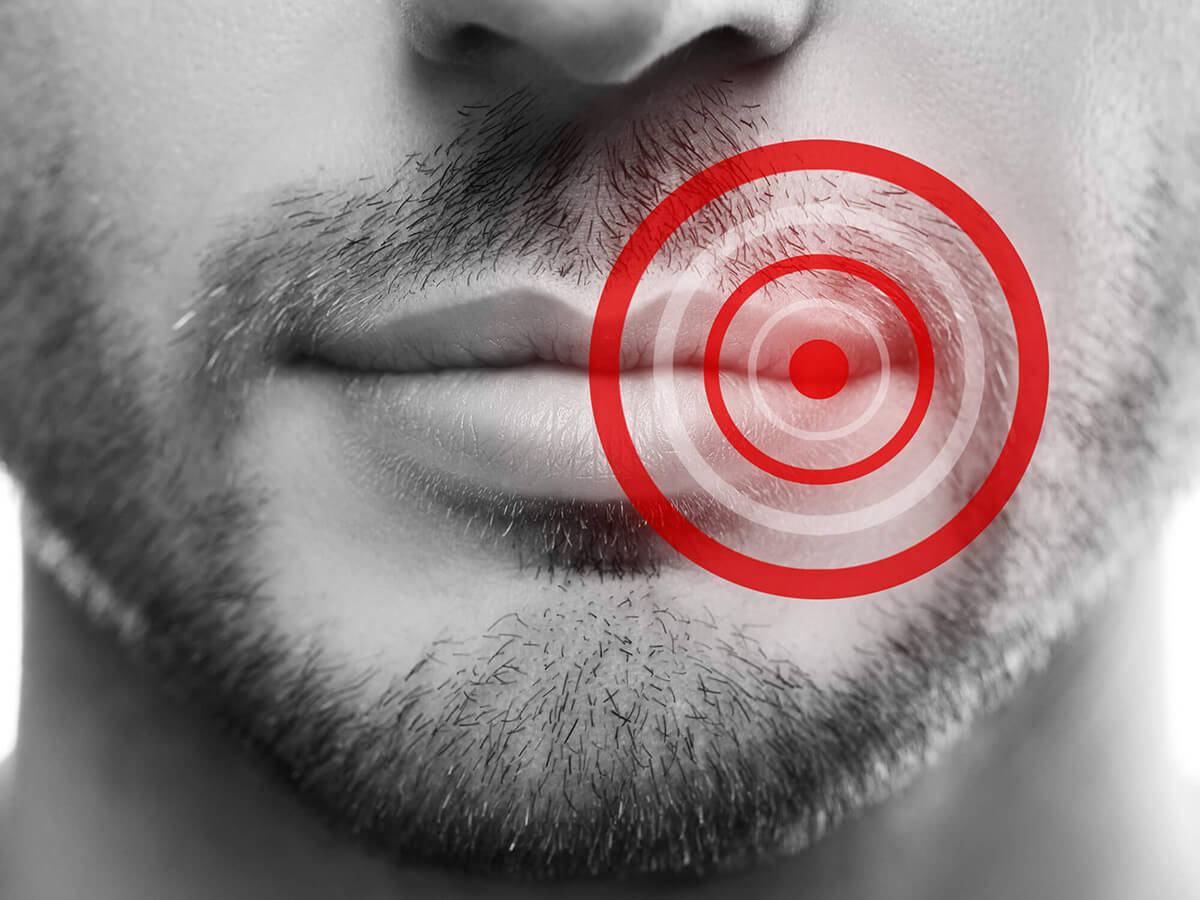 Cold Sore Treatment - Georgetown, KY - ThoroughDent Smiles